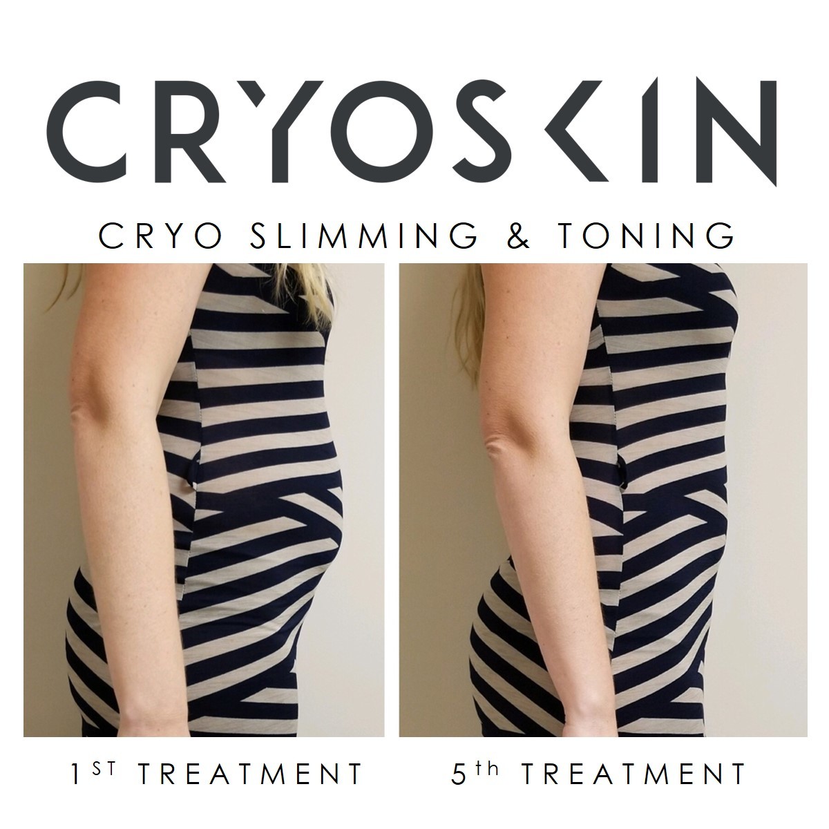 CryoSkin Before and After Photos - Simply Kneaded