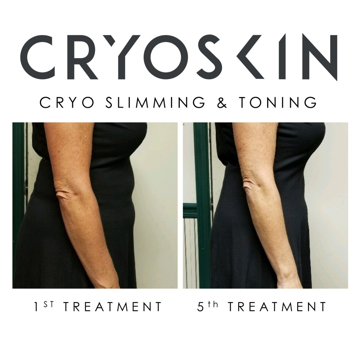CryoSkin Before and After Photos - Simply Kneaded