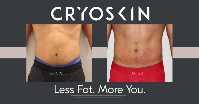 CryoSkin Before and After Photos - Simply Kneaded